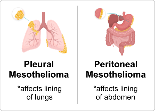 Peritonio Visceral Vs Peritonio Parietal Peritoneal Cavity